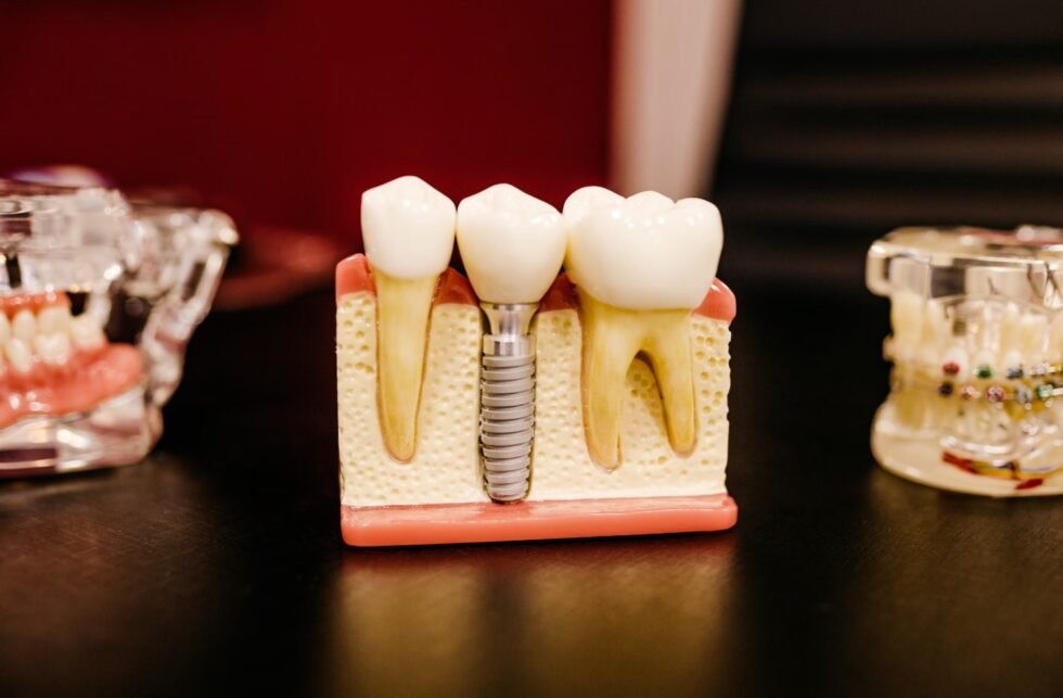 Dental Implants for Missing Teeth Christchurch | Sweet Tooth Dental
